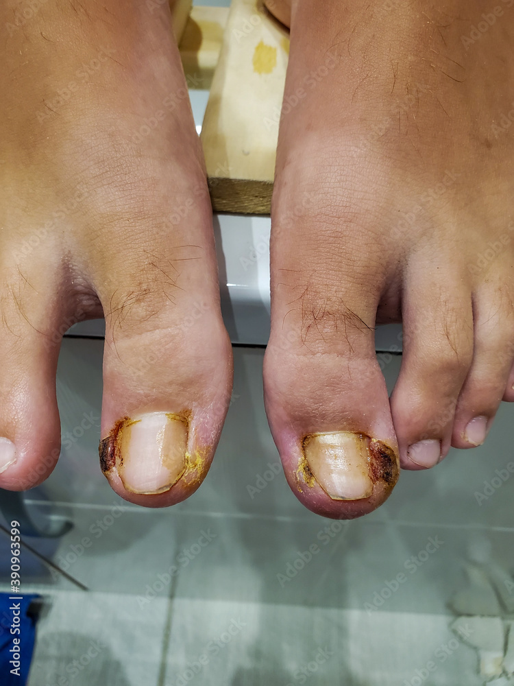 Treat an inflamed big toe with an ingrown toenail. An ingrown toenail ...