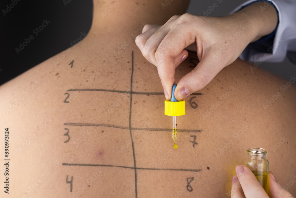 An allergist in the laboratory conducts an allergy prick-test. Skin ...