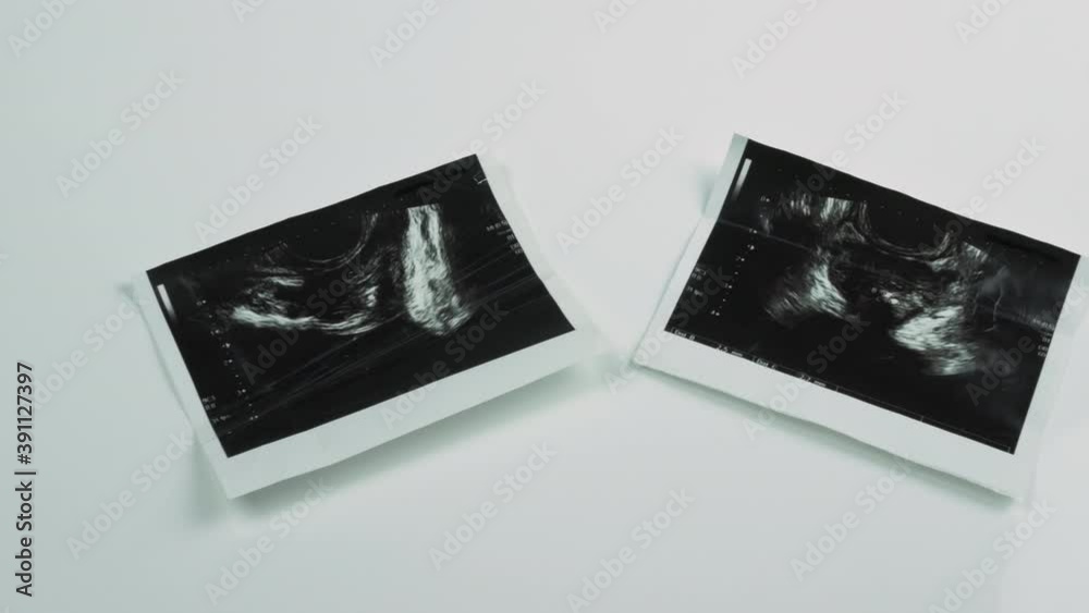 Ultrasound of the prostate, men on a white background. Picture of the ...