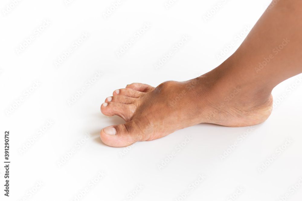 Hallux valgus, big abnormal feet bones of female feet on white ...