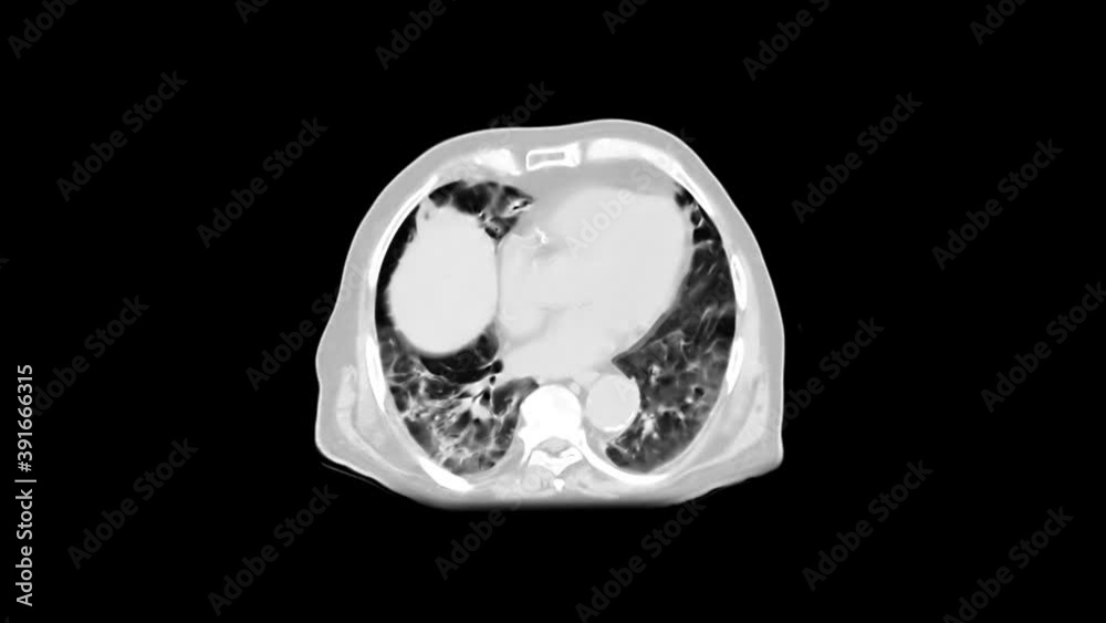 Coronavirus covid19, computed tomography of the lungs with pneumonia ...