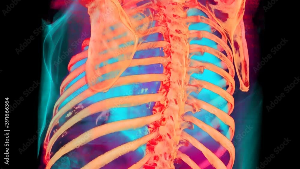 Human chest, ribs and lungs. Computed tomography of the lungs with ...