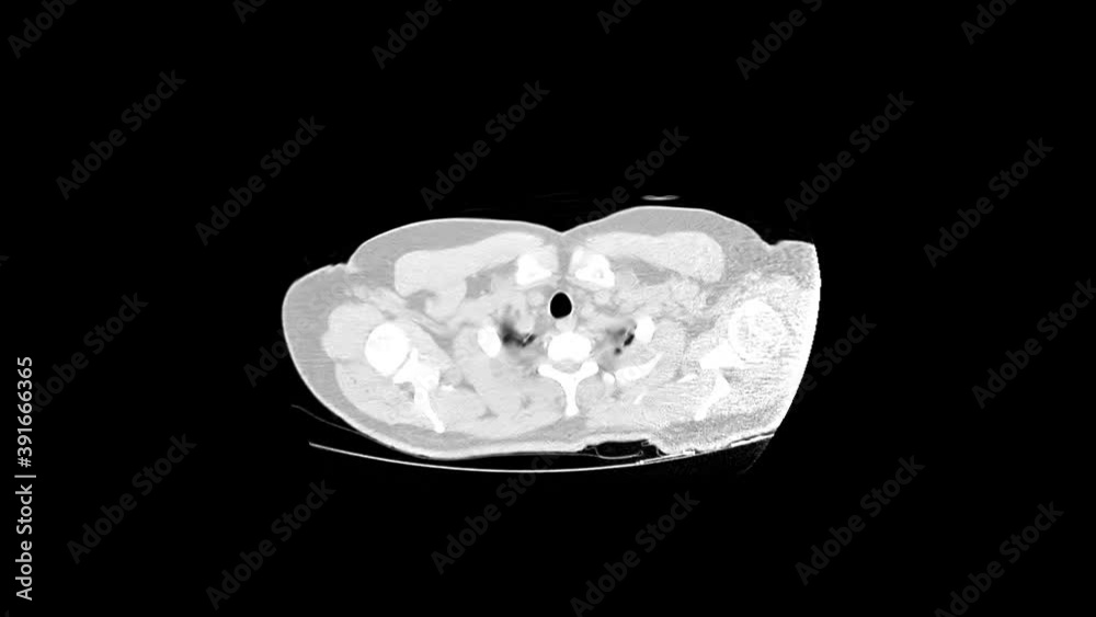 Computed tomography of the lungs with pneumonia, coronavirus disease, diagnosis Thorax -Lung ...