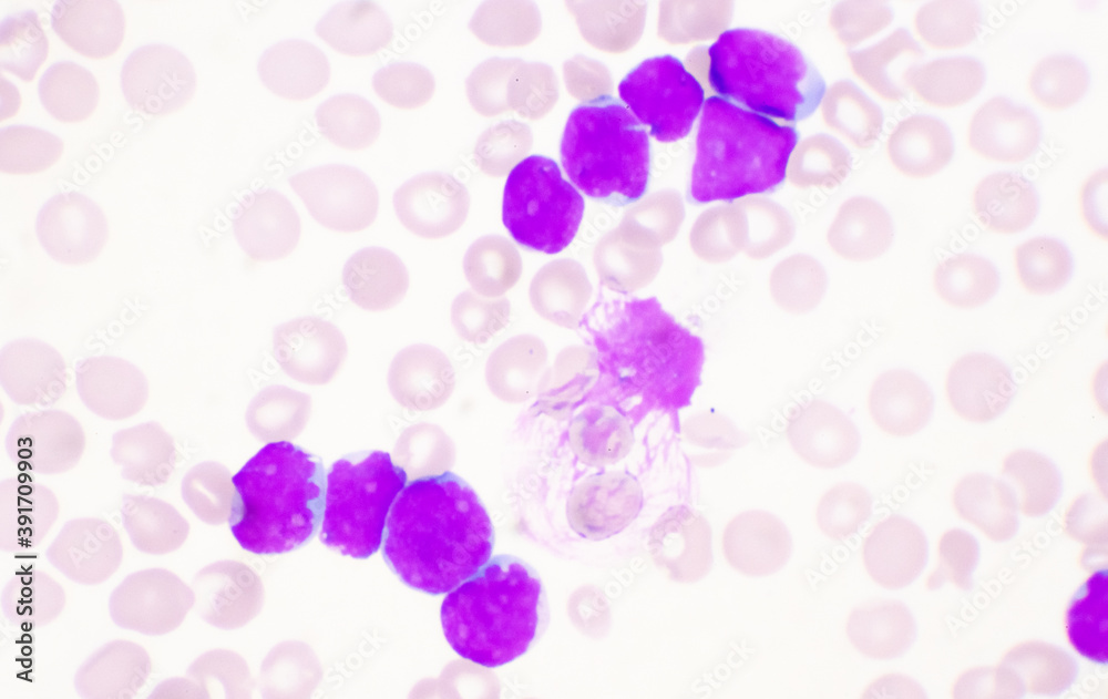 Moderate blast cell of white blood cells in blood smear. Stock Photo ...