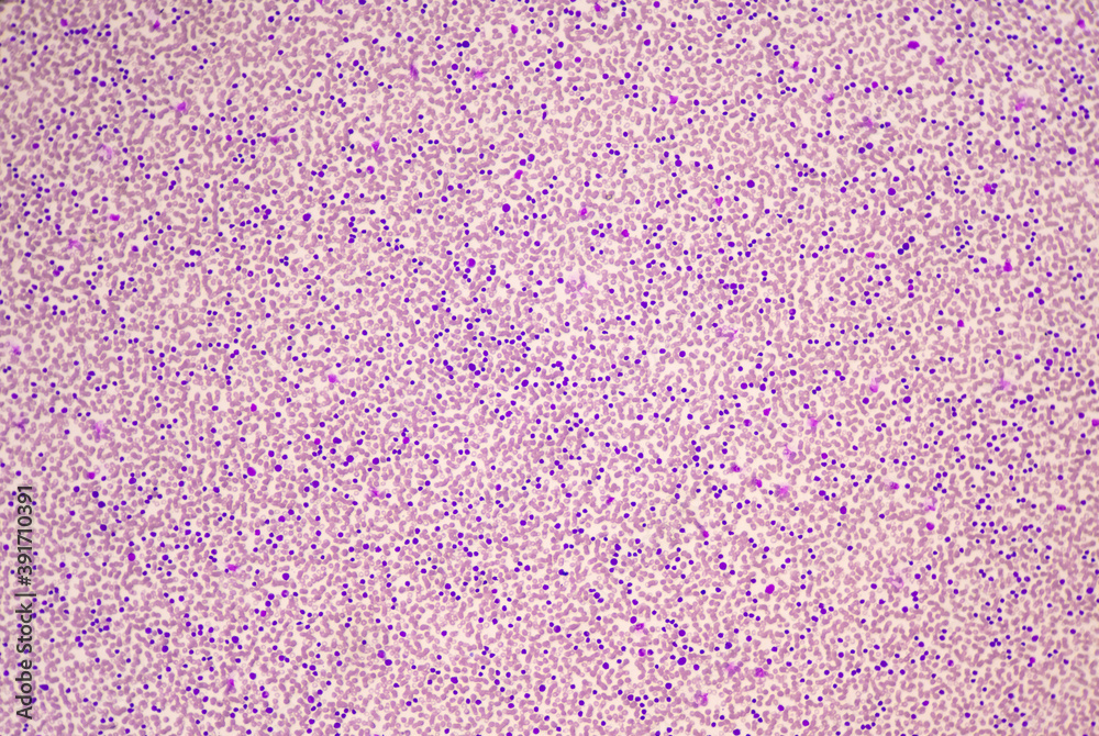Moderate blast cell of white blood cells in blood smear. Stock Photo ...
