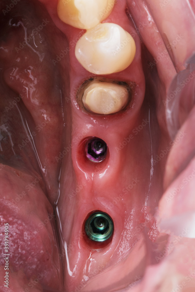 gum with orthopedic prosthetics before installing ceramic crowns in the ...