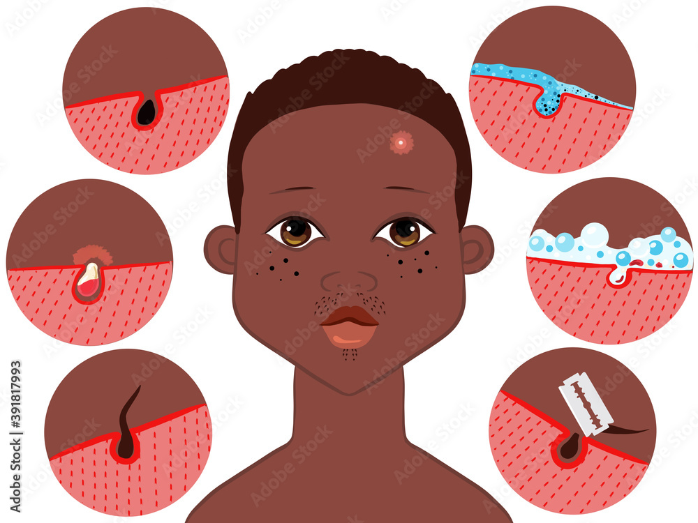 Infographics of teenage skin problems. Teen boy battling acne ...