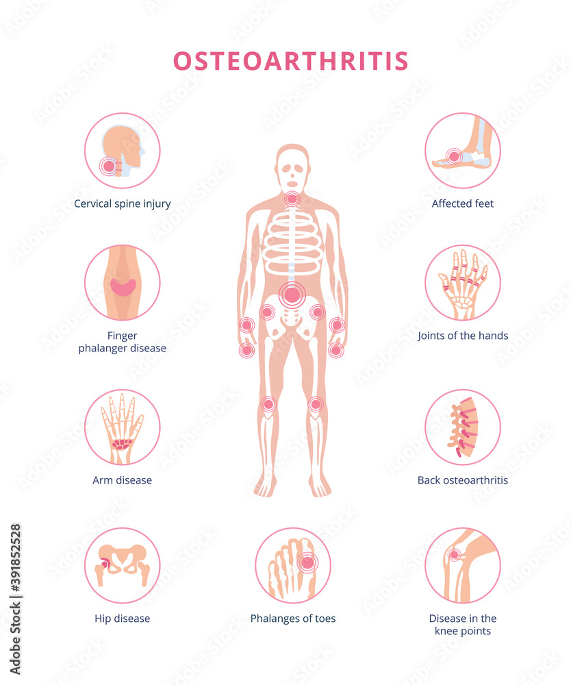 Medical scheme of osteoarthritis joint damage, flat vector illustration ...