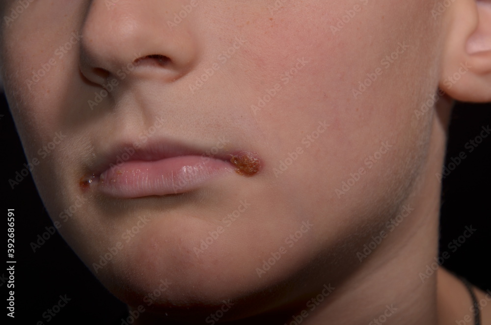 infection on the lips angular cheilitis inflammation of both corners of ...