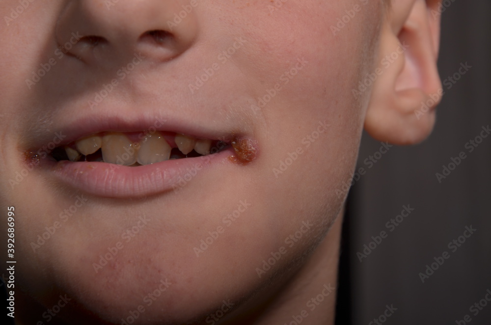 infection on the lips angular cheilitis inflammation of both corners of ...