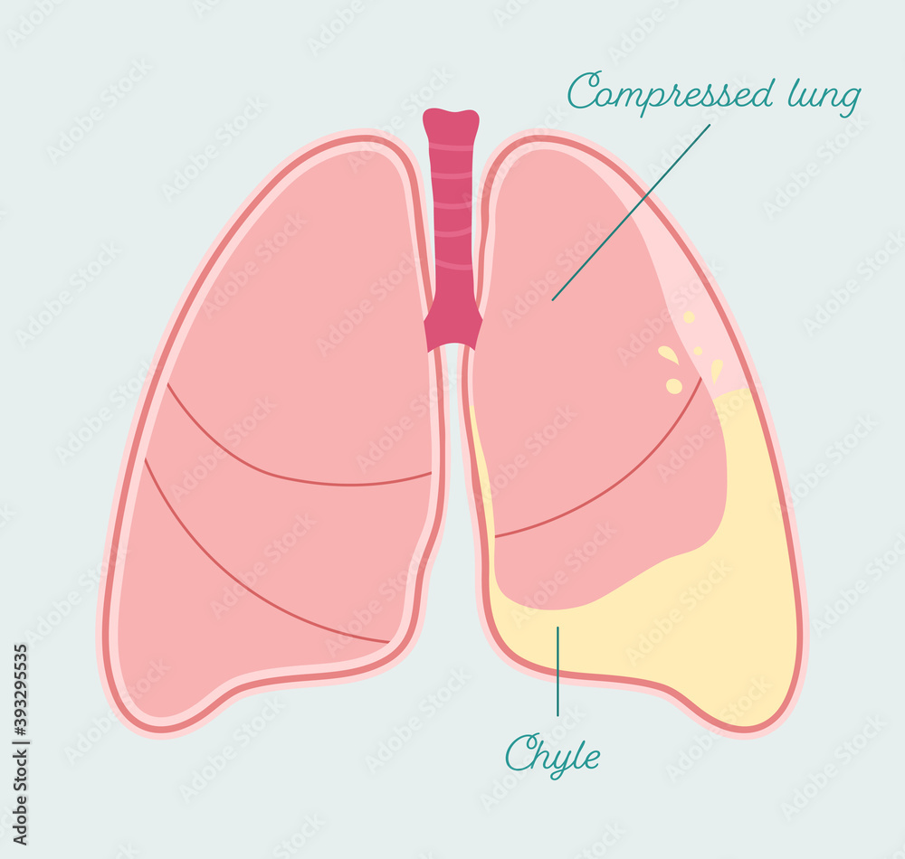Chylothorax - anatomical scheme in hand drawn style. Gathering of chyle ...