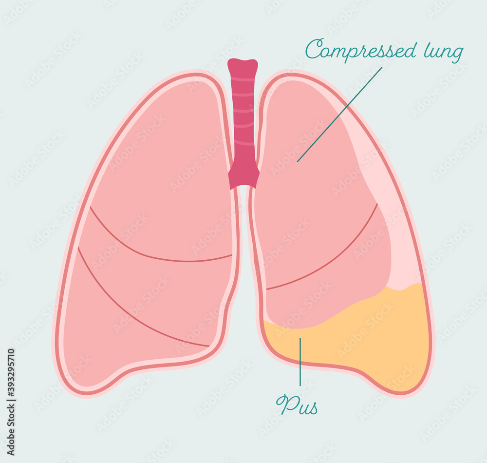 Pleural empyema - anatomical scheme in hand drawn style. Gathering of ...
