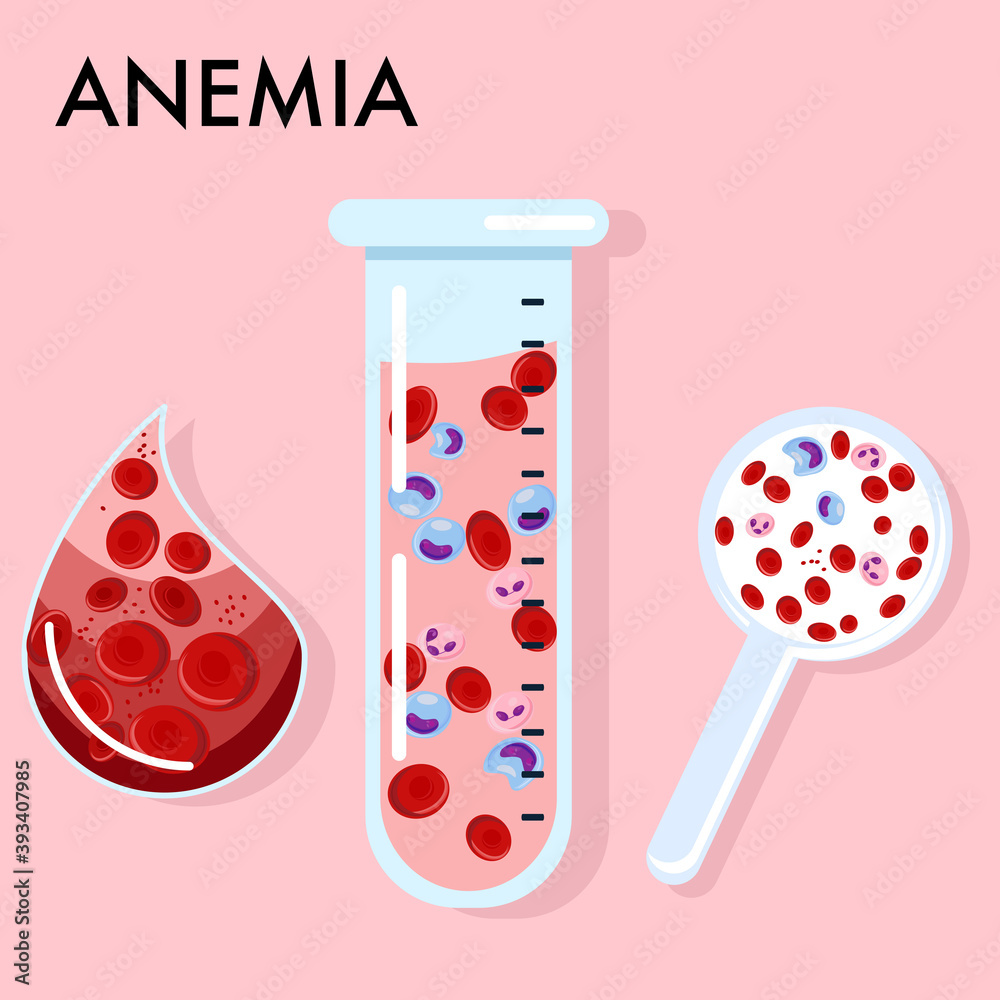 Anemia concept.Glass laboratory test tube and magnifier with blood ...