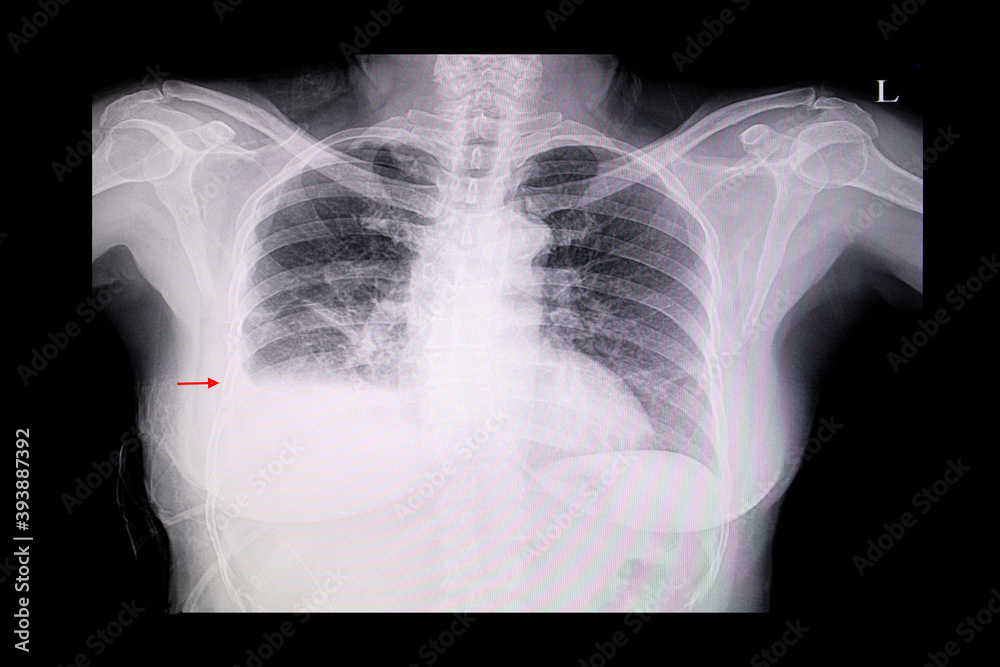 Chest xray of cardiomegaly , pulmonary edema and pleural effusion ...