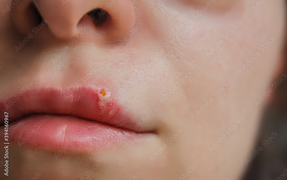 Macro photo of lips on woman's face with herpes virus. Stock Photo ...