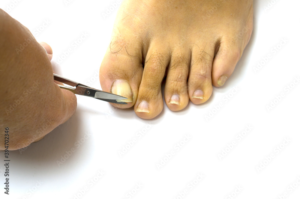 Cutting toenails. Pedicure. Broken toenail on white background. Stock ...