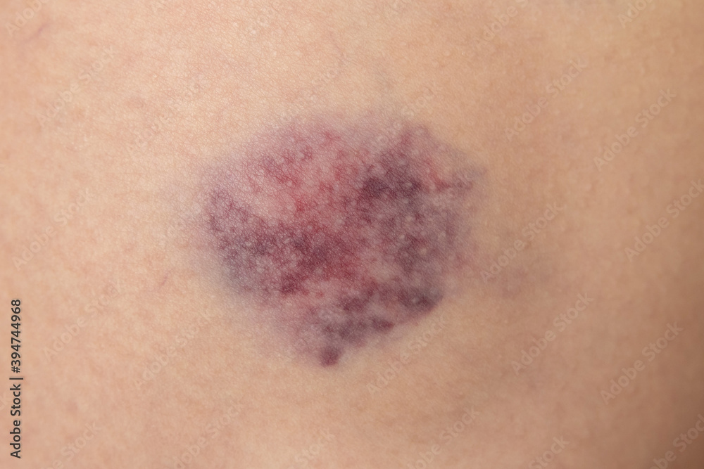 Bruise Skin Texture Stock Photo | Adobe Stock