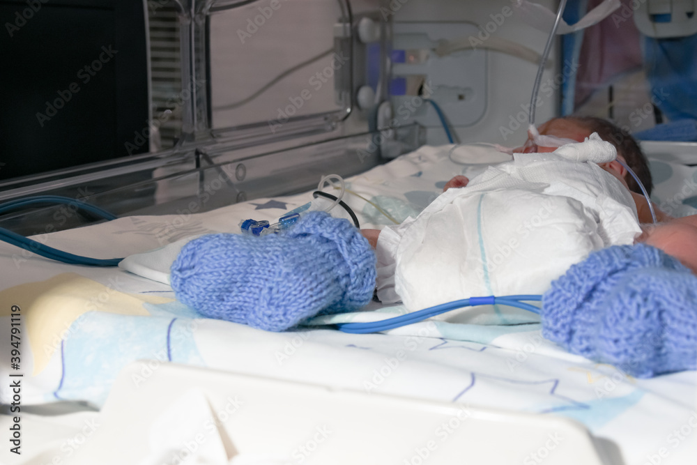 Premature newborn is on a ventilator, recovering in incubator. His feet ...