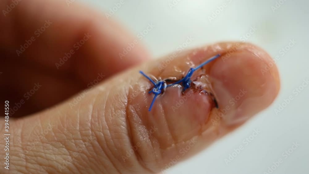 Vidéo Stock Close-up of clear liquid dripping on dry skin and stitches ...