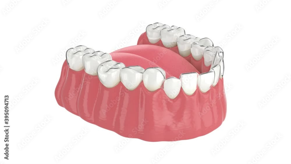 Clear invisalign aligner splint make bite correction Stock Video ...