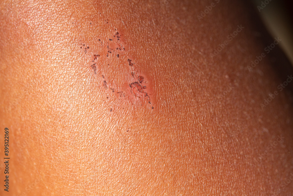 A wound on the human body. Very close up of painful wound. Stock Photo ...