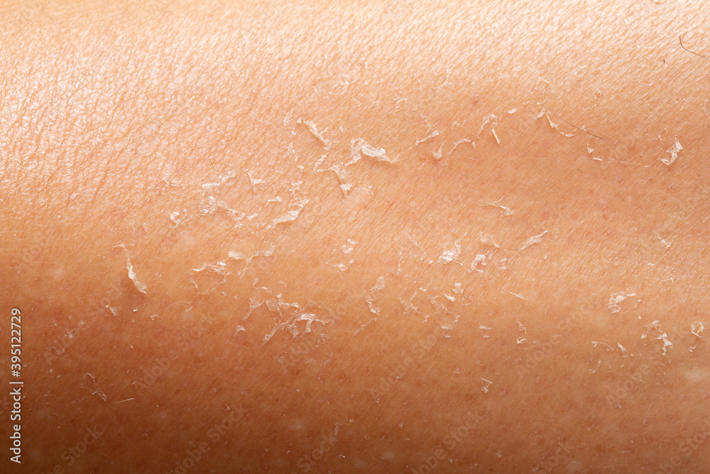 unhealthy human skin epidermis texture with flaking and cracked ...