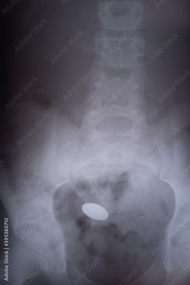 X-ray of a child with a foreign body battery in the gastrointestinal ...