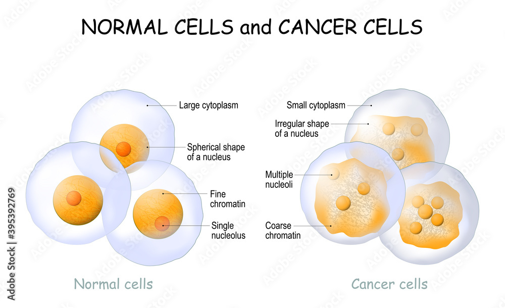 Cancer cells and Normal cells. comparison and difference Stock Vector ...