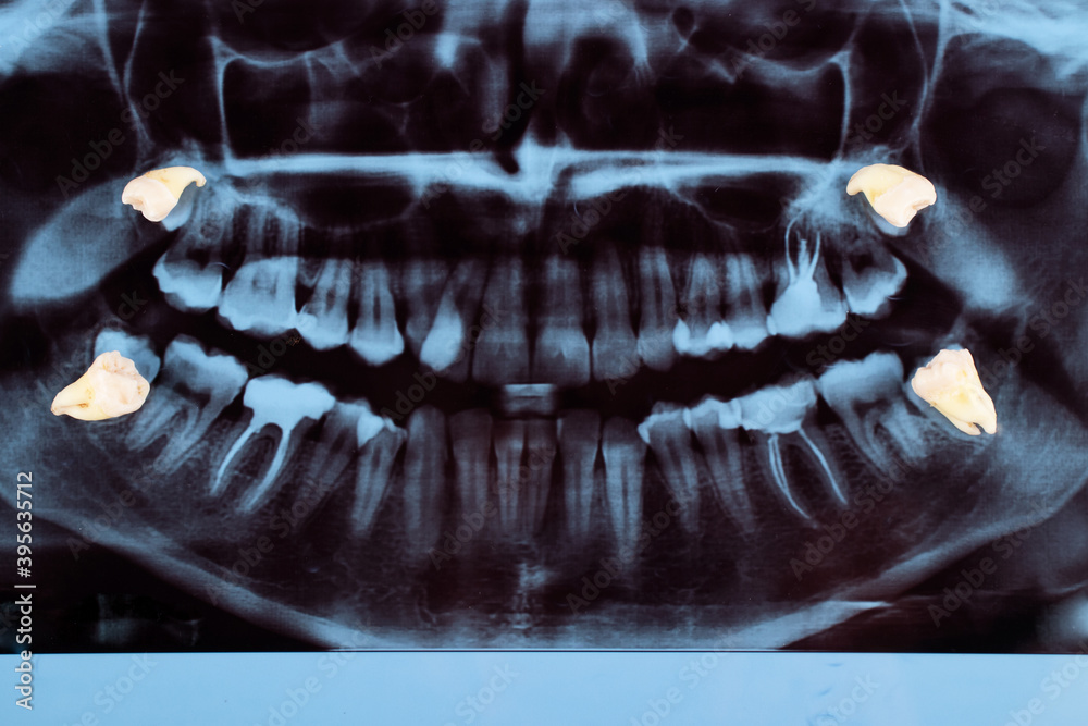 Dental panoramic x-ray. Medical concept. Dental treatment. Extraction ...