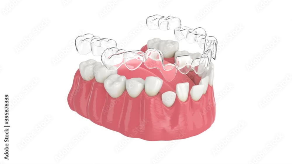 Clear invisalign aligner splint make bite correction vídeo de Stock ...