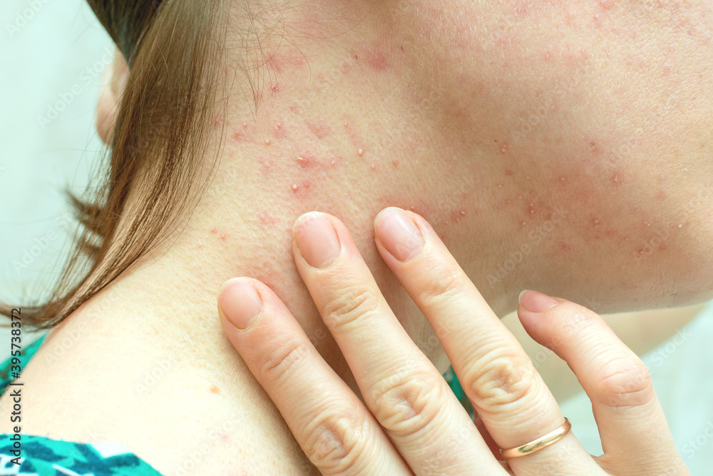 Purulent rashes on the neck of woman. Allergy, acne. Skin diseases ...