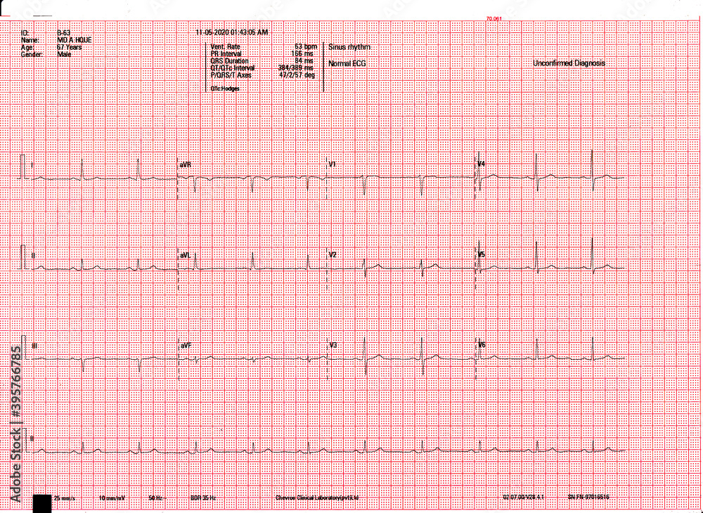 A normal resting ECG report of a patient. Echocardiogram report of a 67 ...