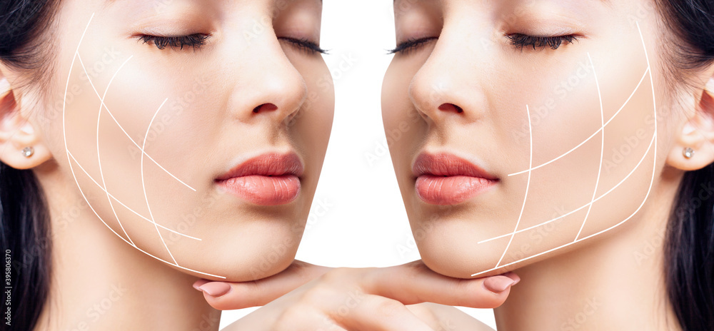 Young beautiful woman with lifting lines before and after chin ...