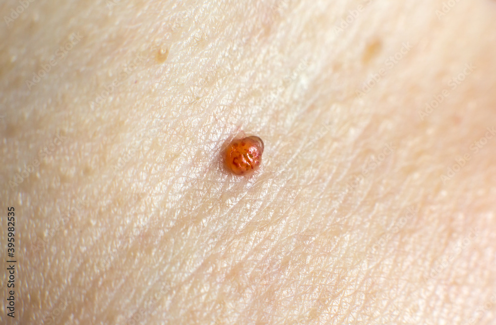 Big birthmark on skin. Medical health photo. Papillomas on human body ...