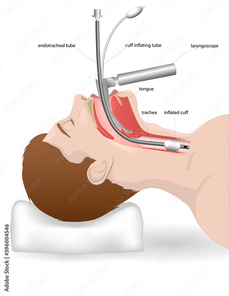 Intubation for a patient with respiratory arrest or difficulty in ...