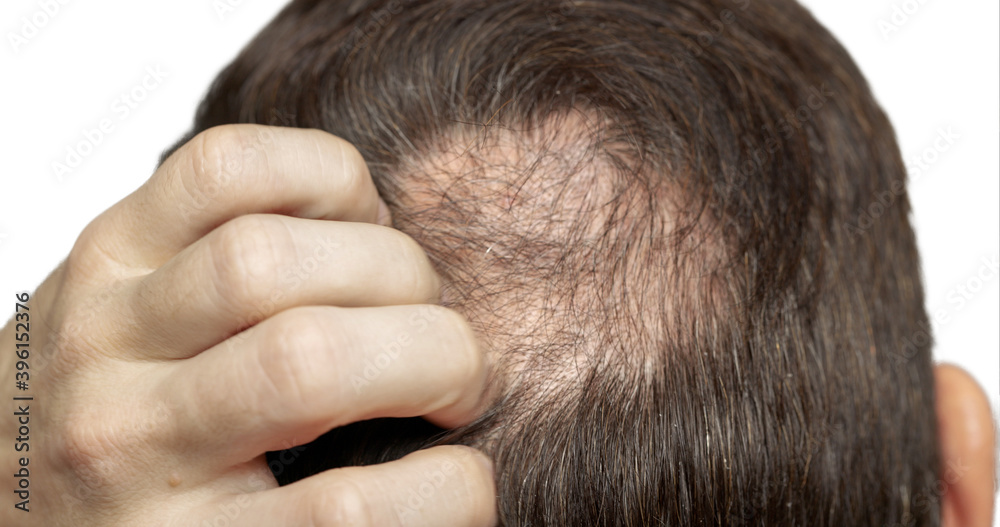 Man with hair loss problems closeup, isolated. Alopecia balding hairs ...