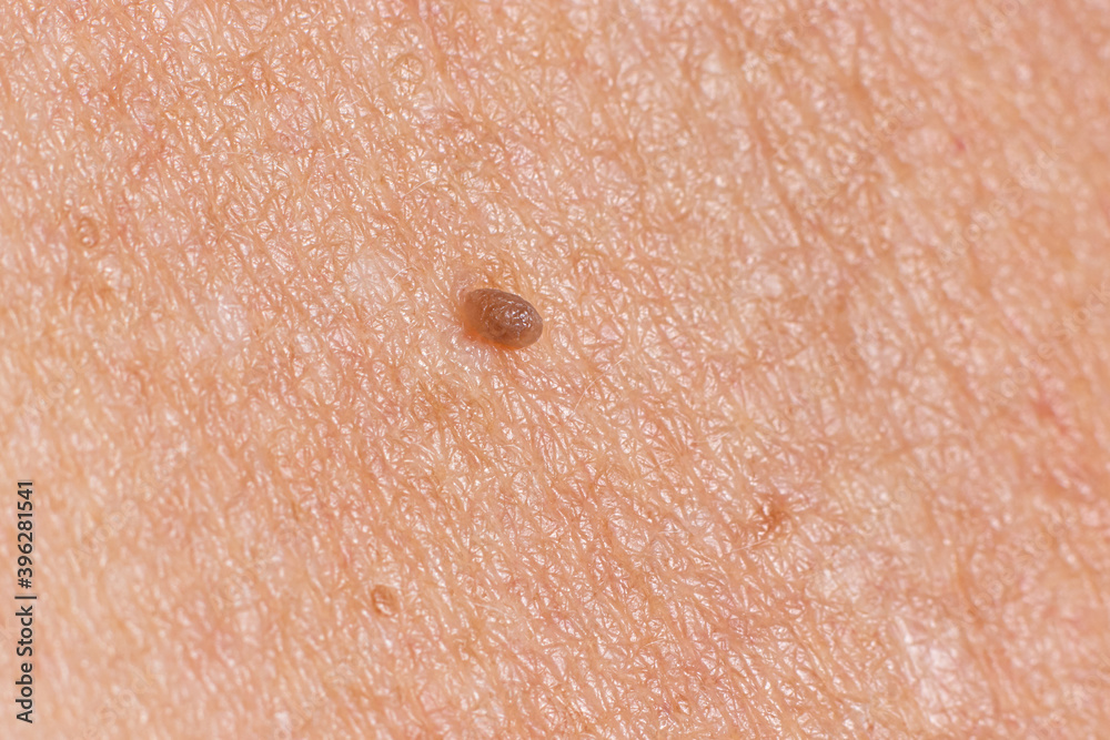 Papilloma on human skin - benign tumor in the form of mole, nevus ...