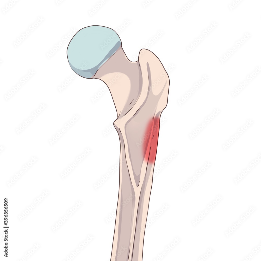 Gluteal tuberosity. The femur, or thigh bone, is the proximal bone of ...