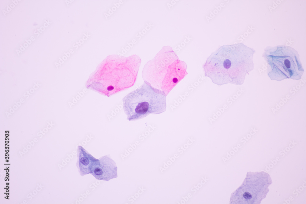 View in microscopic of Abnormal human cervix cells.Squamous epithelium ...