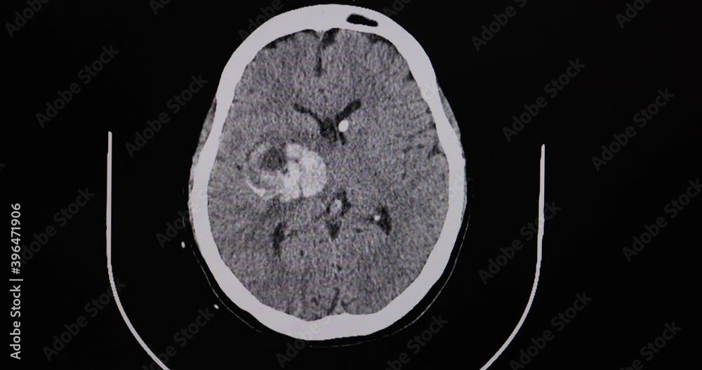 A CT cinescan of a stroke patient showing bleeding in the right basal ...