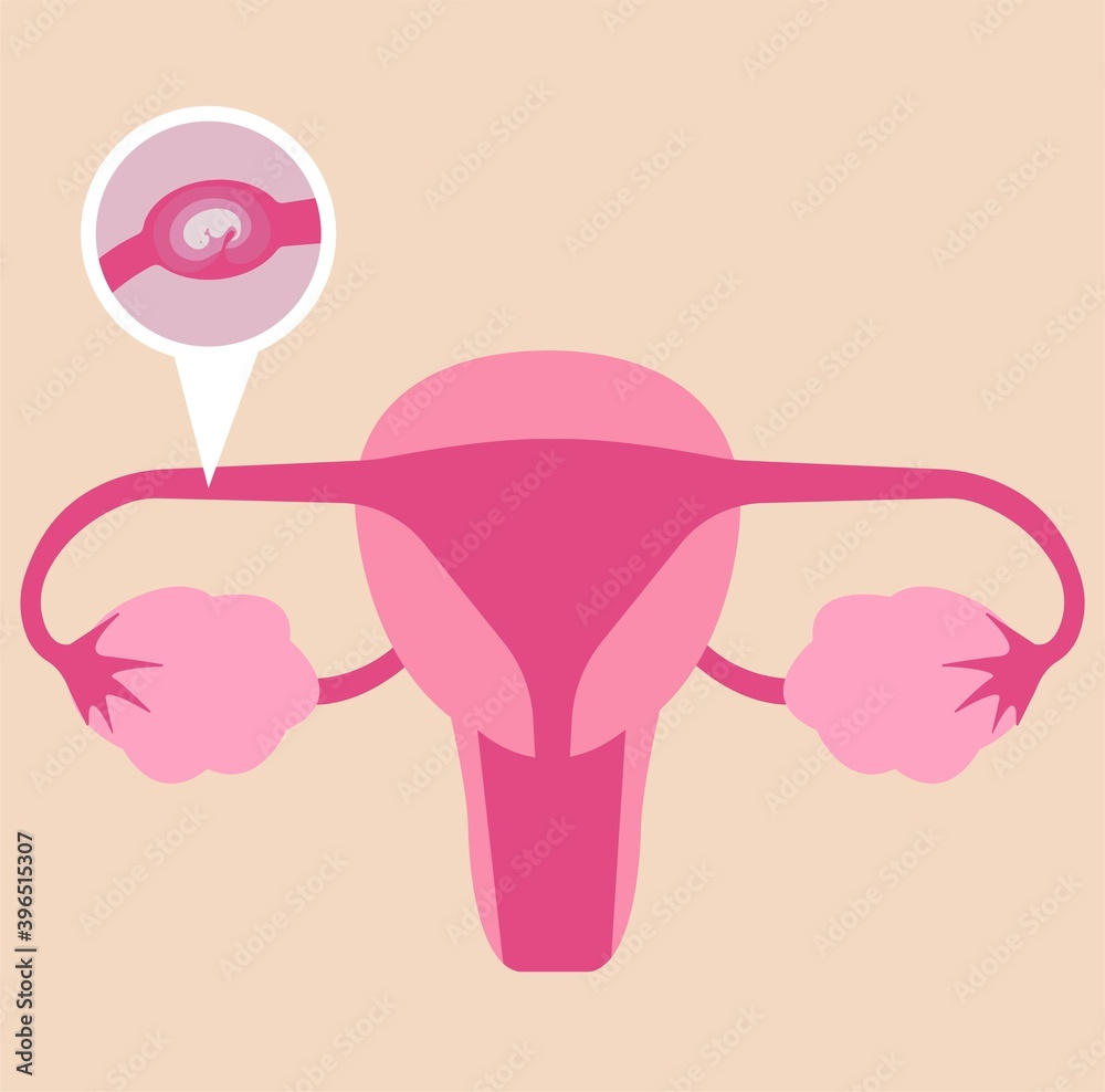 Ectopic pregnancy or fallopian tubes pregnancy. Stock Vector | Adobe Stock