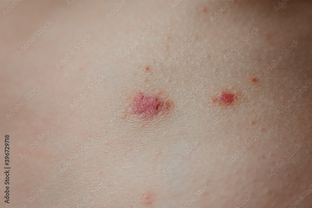 Psoriasis vulgaris skin. Psoriasis is an autoimmune disease that ...