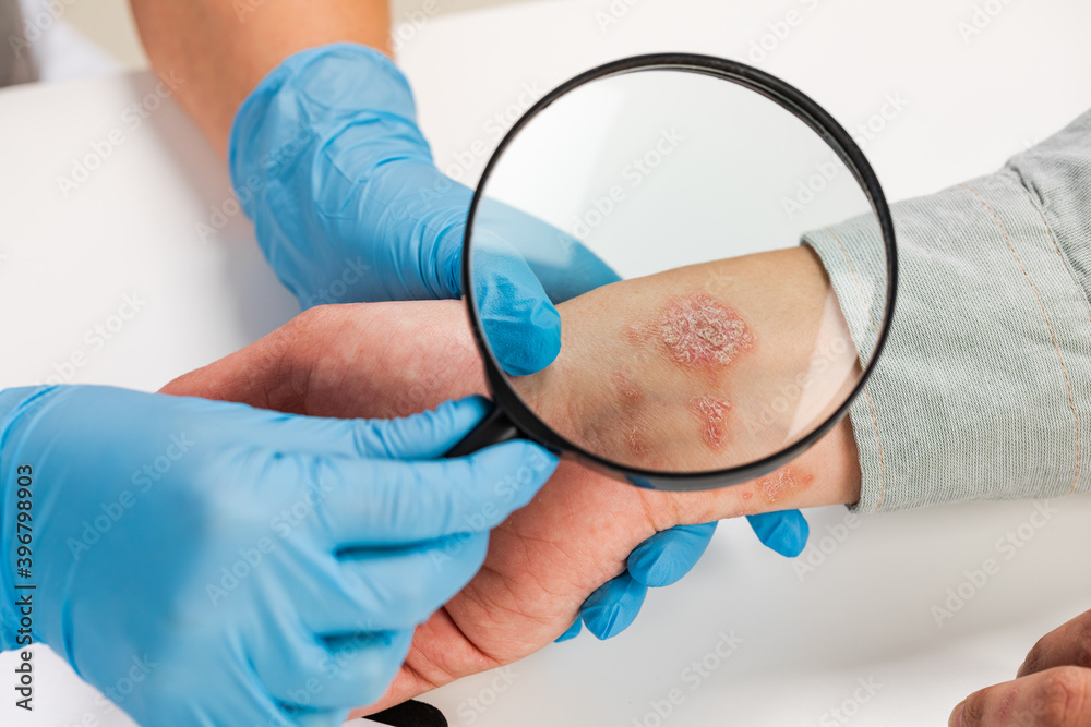 A dermatologist wearing gloves examines the skin of a sick patient ...