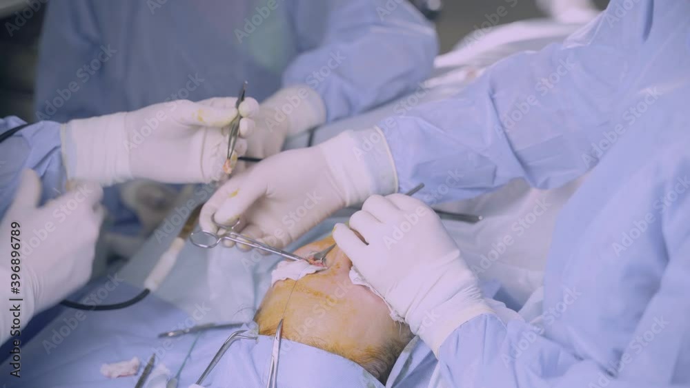 Transconjunctival blepharoplasty. Surgery. Upper blepharoplasty ...