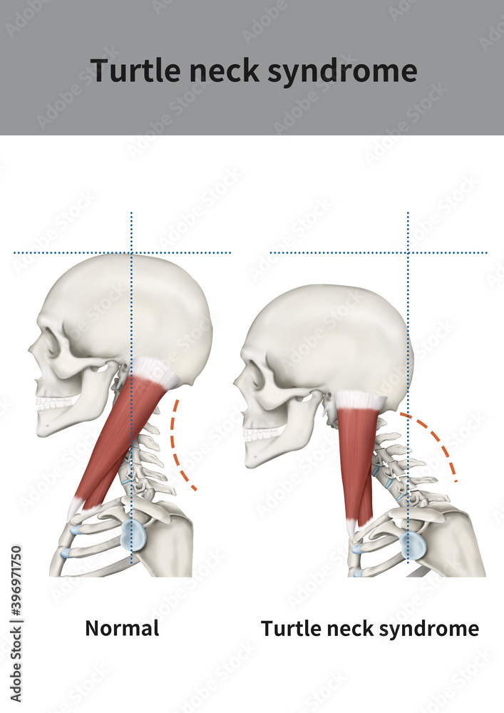 Medical illustration for explanation turtle neck syndrome Stock 일러스트레이션 ...