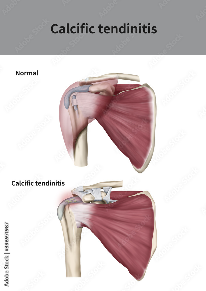 Medical illustration for explanation Calcific tendinitis Stock ...