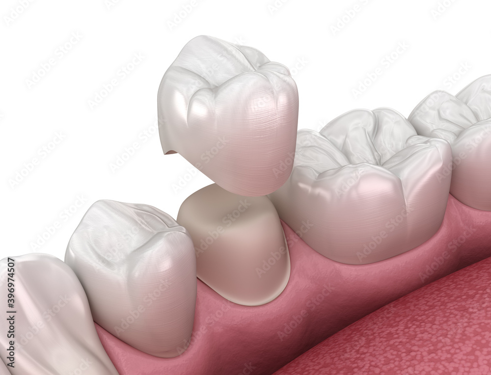 Preparated premolar tooth and dental crown placement. Medically ...