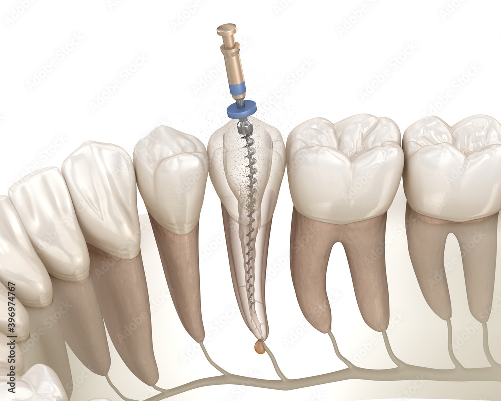 Endodontic root canal treatment process. Medically accurate tooth 3D ...
