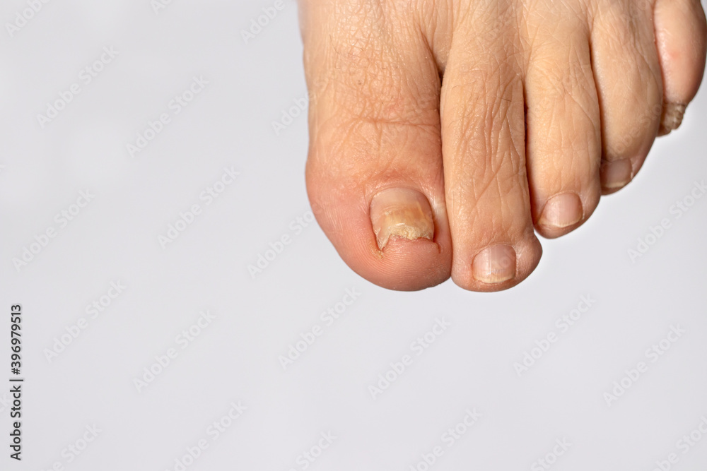 Fungus of nails on the big toe - dermatomycosis and onychomycosis ...