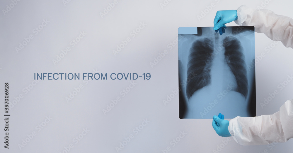 Xray film of Covid 19 lung damage and holding by doctor hand in medical ...